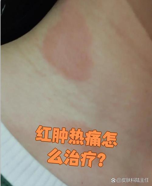 炎症低热和肿瘤低热图标