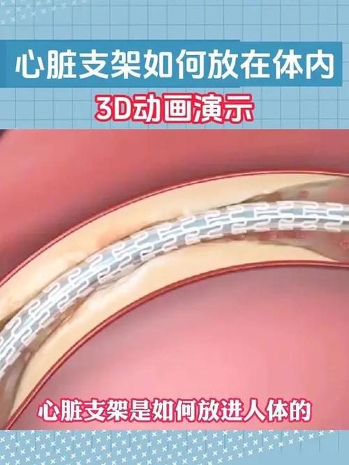 心脏支架一次放7个