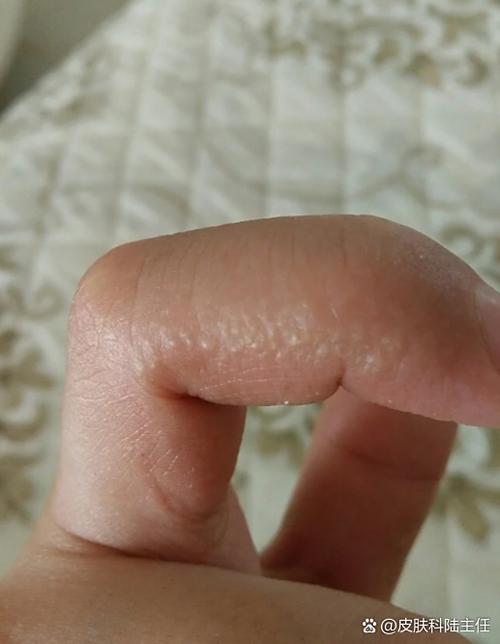 手被漂粉弄白了截图
