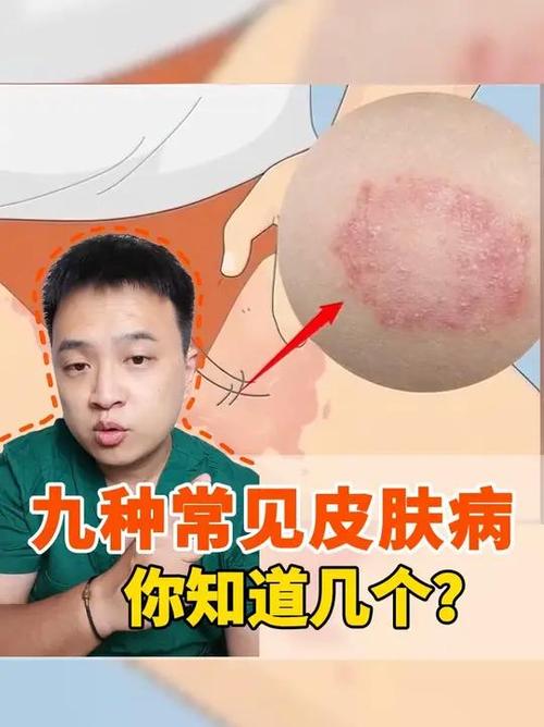 常见的皮肤病有哪些?图标