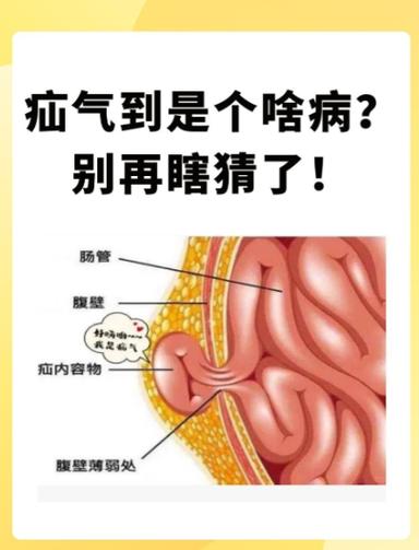 男士疝气是怎么形成的图标