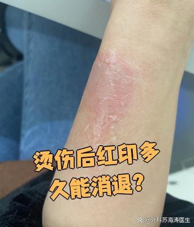 烫伤红印去除小妙招截图