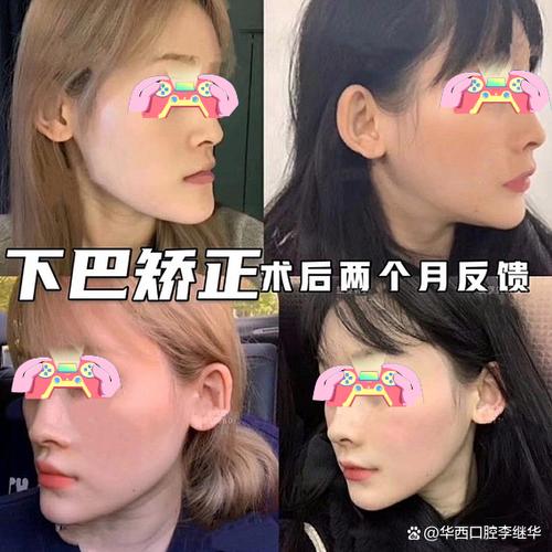 做正颌手术的最佳年龄图标