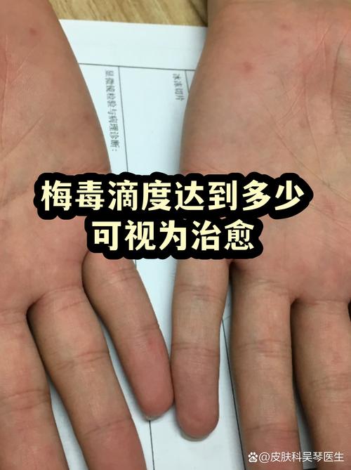 梅毒滴度多少算治愈了图标