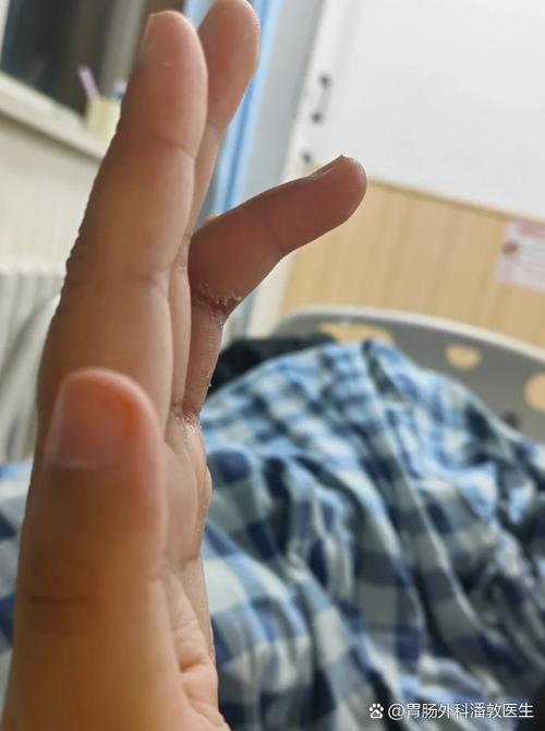 手指断了恢复的概率截图