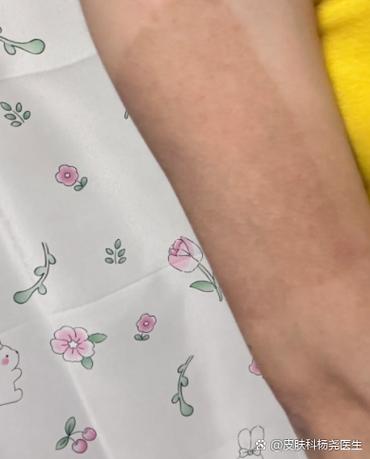 膏药印怎么去除妙招截图