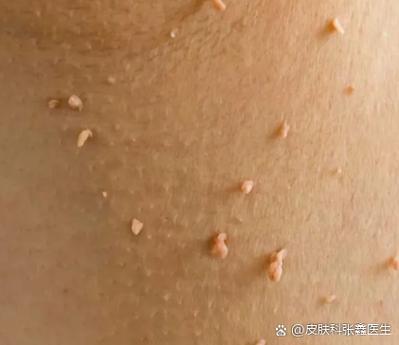 hpv病毒感染的症状图标