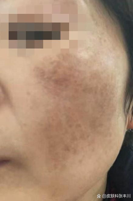中年女人脸上长斑怎么去掉图标