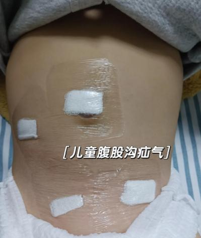 肠疝气怎么治疗最好方法截图