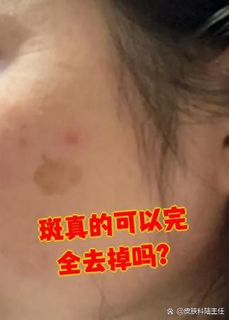 斑能不能彻底去掉