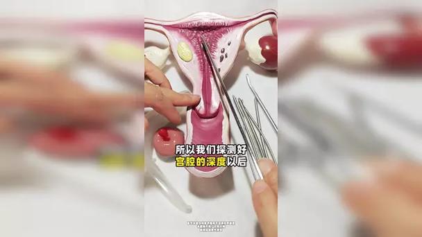 实拍人流手术全过程图标