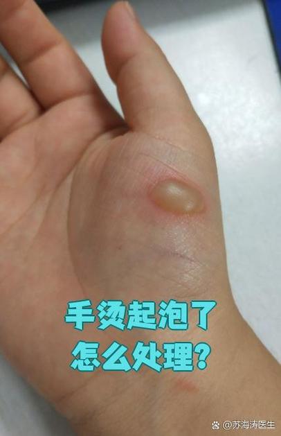 手烫起泡了破了怎么处理好得快图标