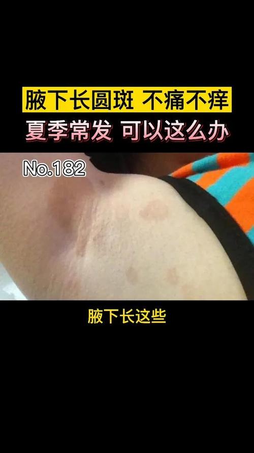 腋下出现褐色斑块是怎么回事