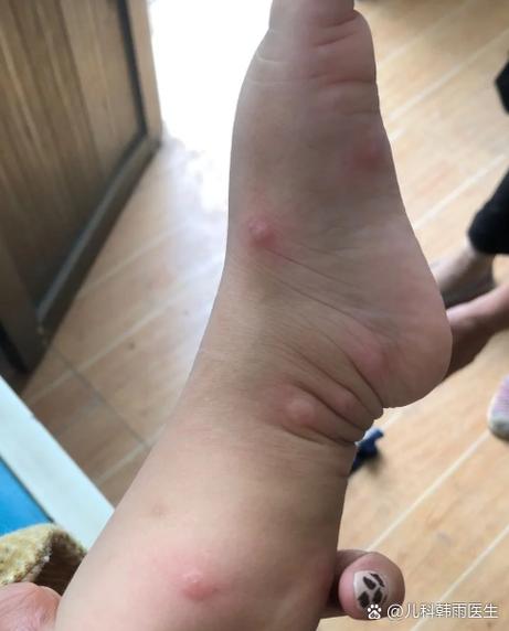 一抓身上就起疙瘩还特别痒怎么办截图