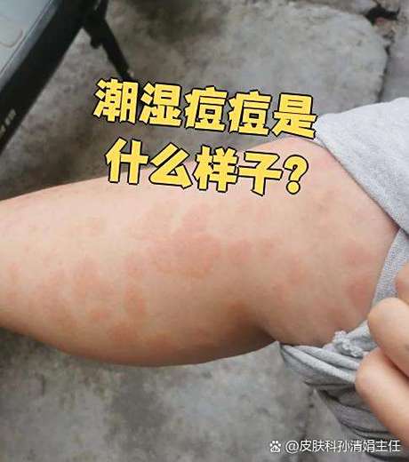 湿毒起疙瘩图片图标