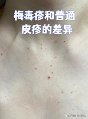 梅毒红斑和普通红斑区别图标