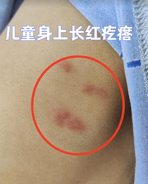 身上长红疙瘩流鼻血图标