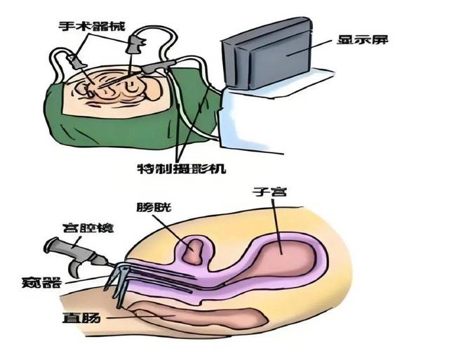 宫腔镜手术怎么做的图标