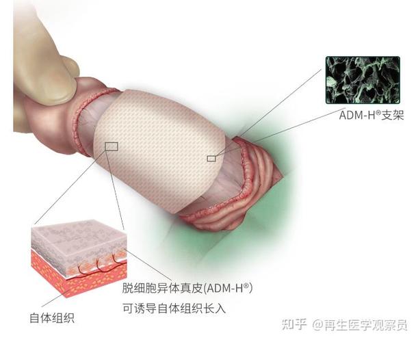 体内置