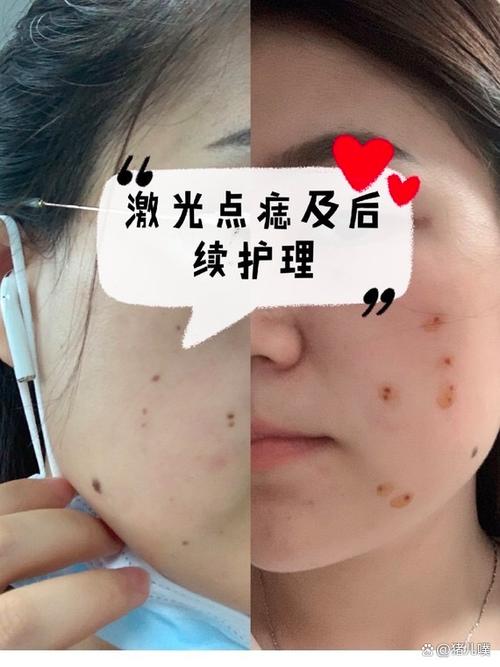 激光留下的黑印怎么去除图标