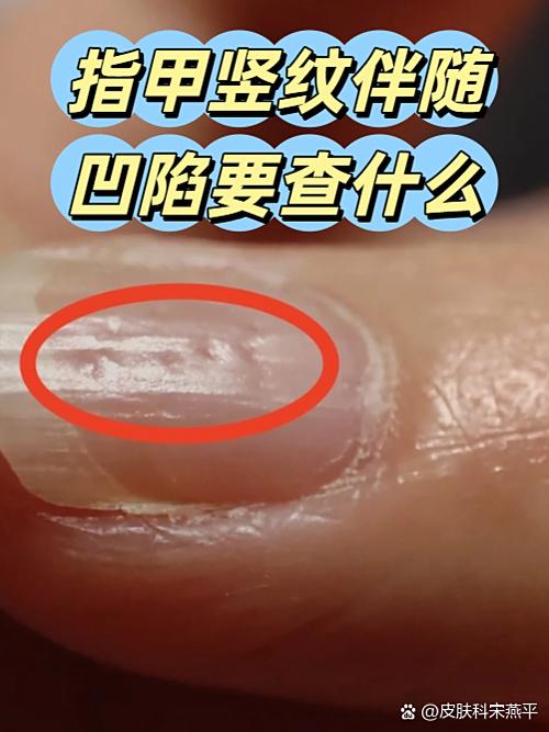 左脚大脚指甲有暗灰色竖线图标