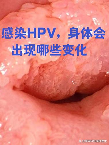 hpv病毒传染吗图标
