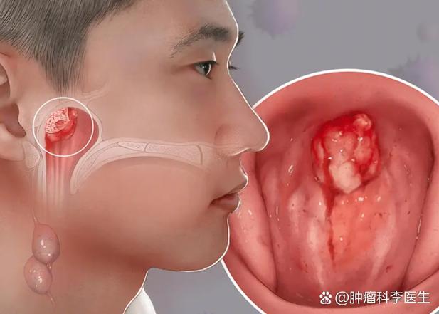 鼻咽癌一旦复发就无法治愈吗图标