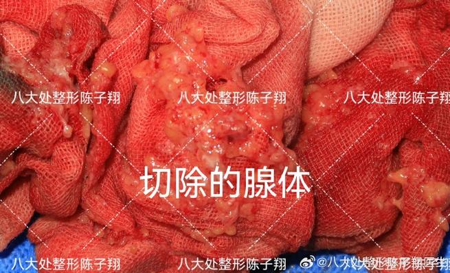 大汗腺切除手术挂什么科截图