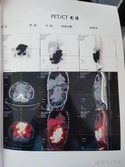 人一旦做petct就意味着什么图标