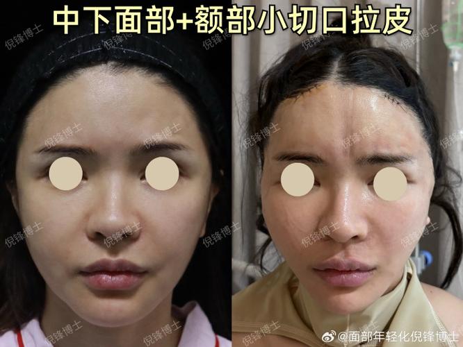 无痕水剥离拉皮是什么图标