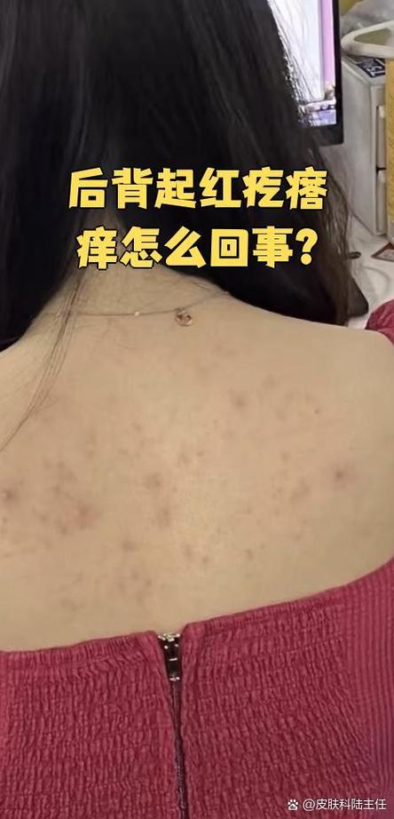 后背起红疙瘩很痒图标