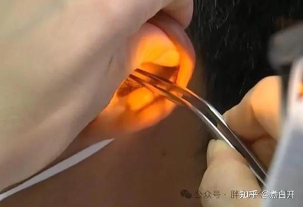 突发性耳朵聋怎么引起的图标