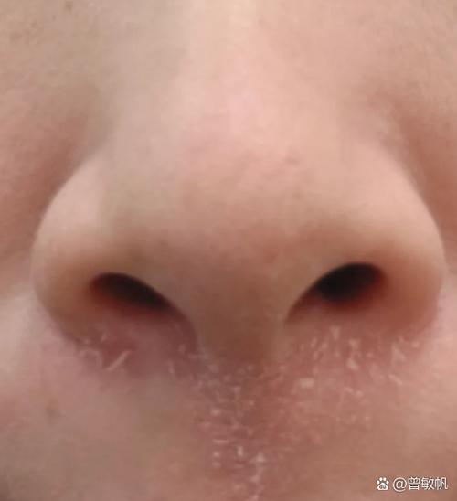 鼻癣的症状图片图标