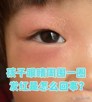 眼周围反复过敏要警惕图标
