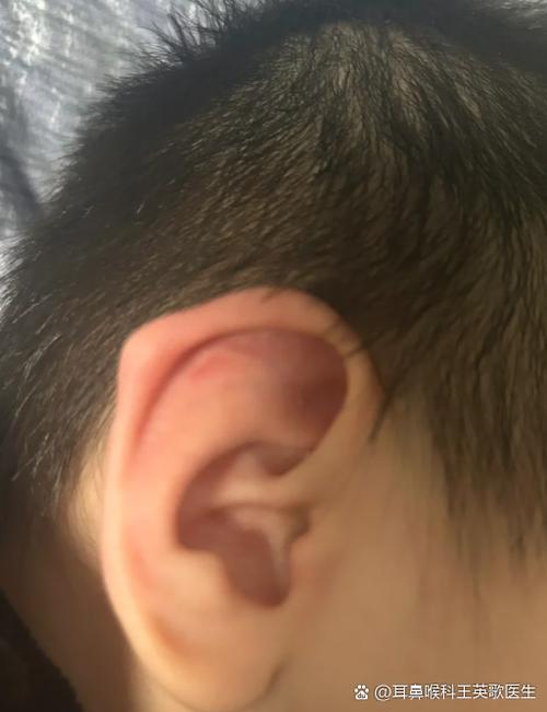耳朵软骨上长了小凸起硬硬的截图