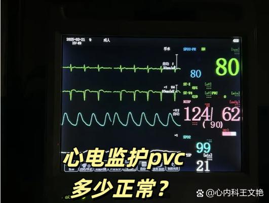 PVC心电监护截图