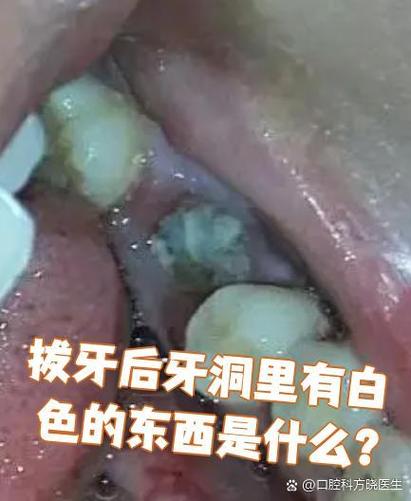 智齿拔了以后有个洞有食物残渣图标