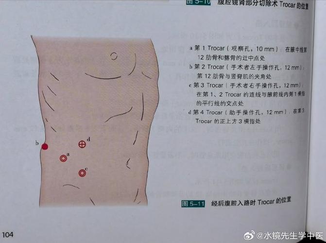 腹腔镜三个洞多久恢复截图
