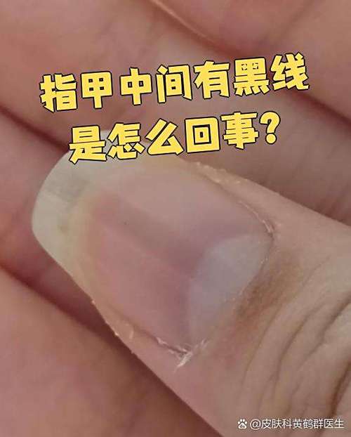 指甲里面有黑线和肝病有关吗截图