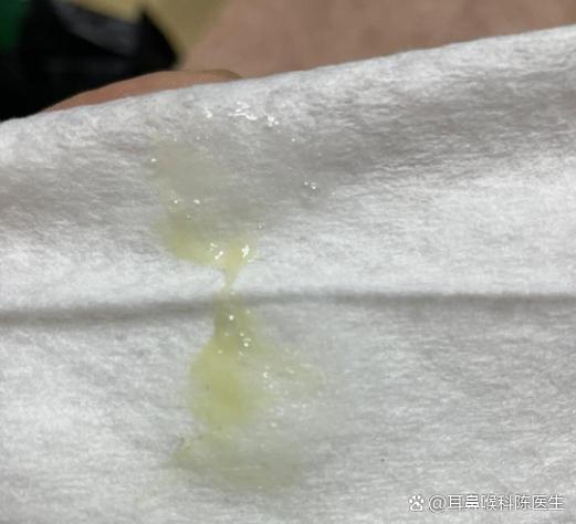 甲硝唑栓5天排出很多脓性图标