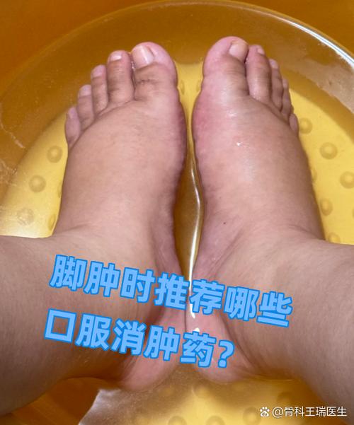 脚肿吃什么药消肿图标