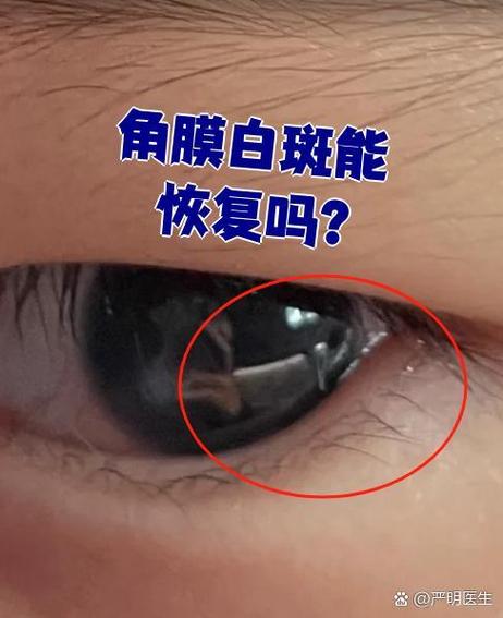 眨眼一瞬间有白色光斑图标