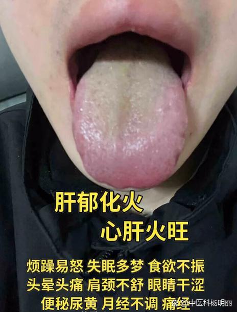 肝火旺会不会流鼻血图标