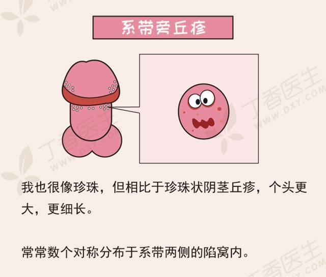 男性生殖有小疙瘩是怎么回事图标
