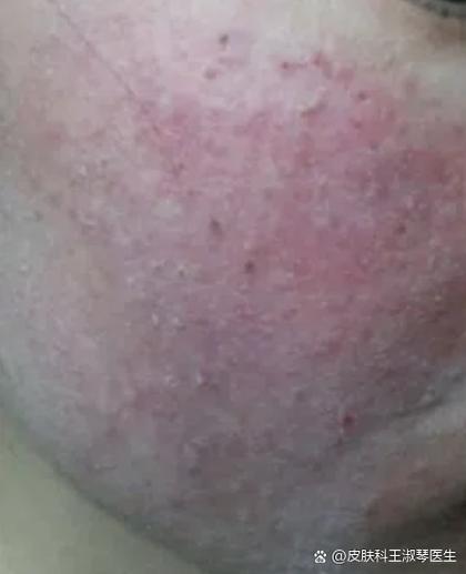 脸一块一块红的还痒还起皮截图