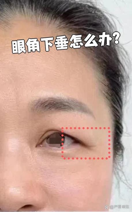 上眼皮松弛下垂图片图标