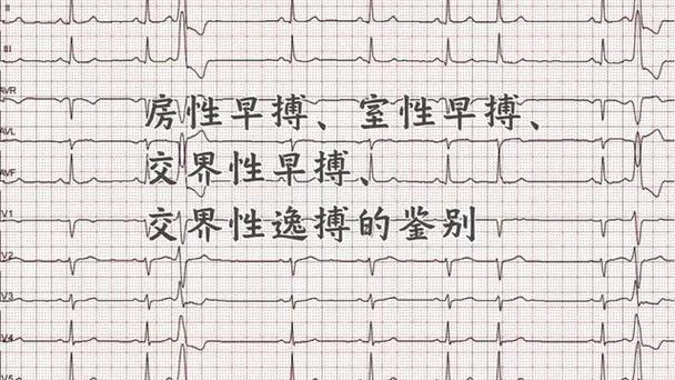 房性早搏和室性早搏哪个严重