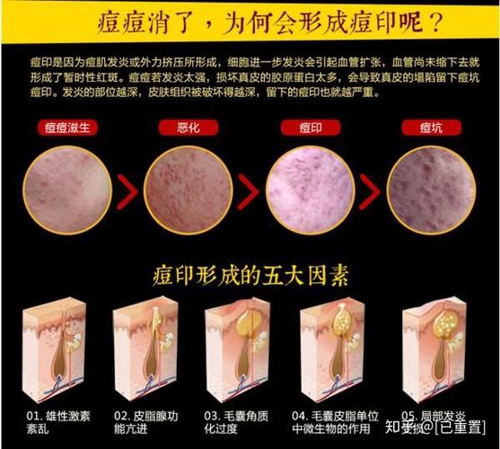 脸上的黑色痘印应该怎样去除图标
