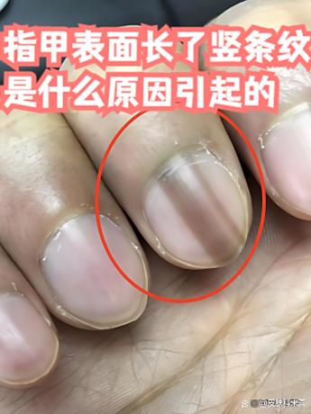 指甲黑纹警惕四种病图标