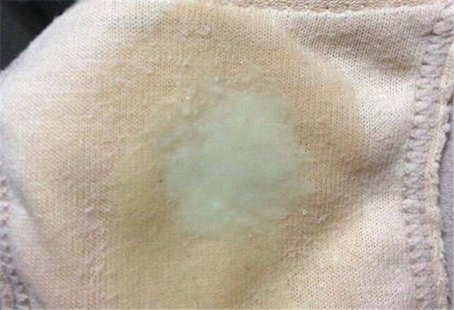 女性分泌物发黄结痂图标